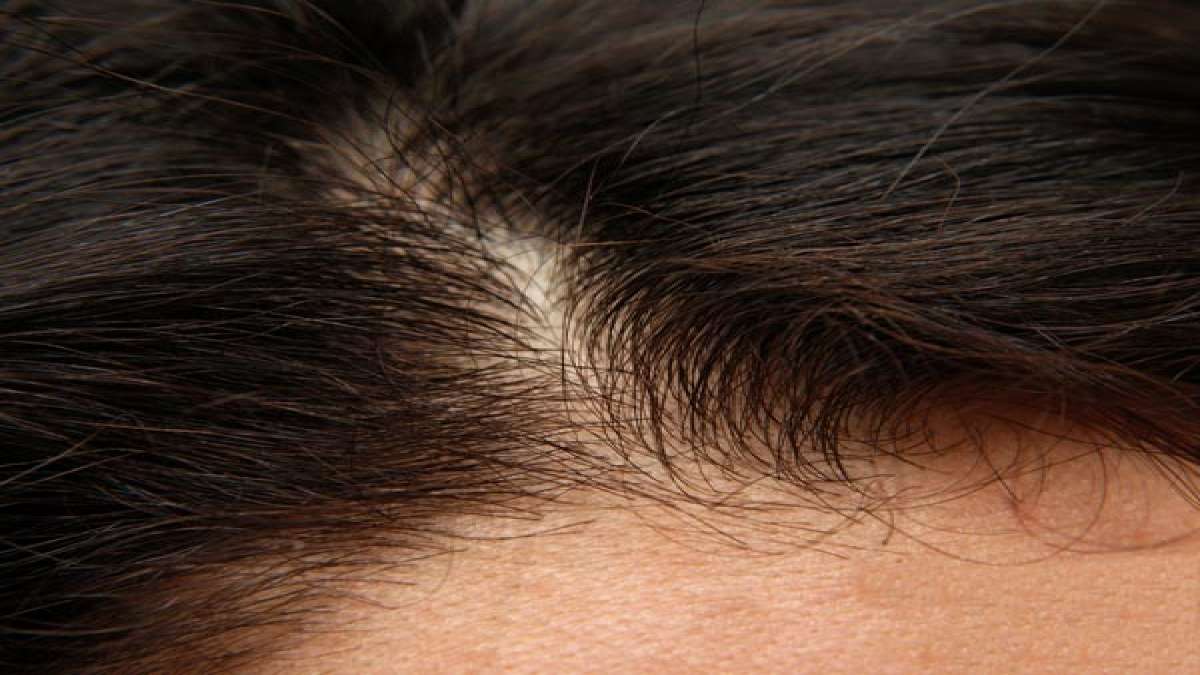 How To Treat Scar Tissue In Scalp? - Boldsky.com
