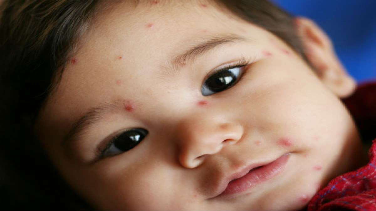 Foods To Avoid When You Have Chicken Pox - Boldsky.com