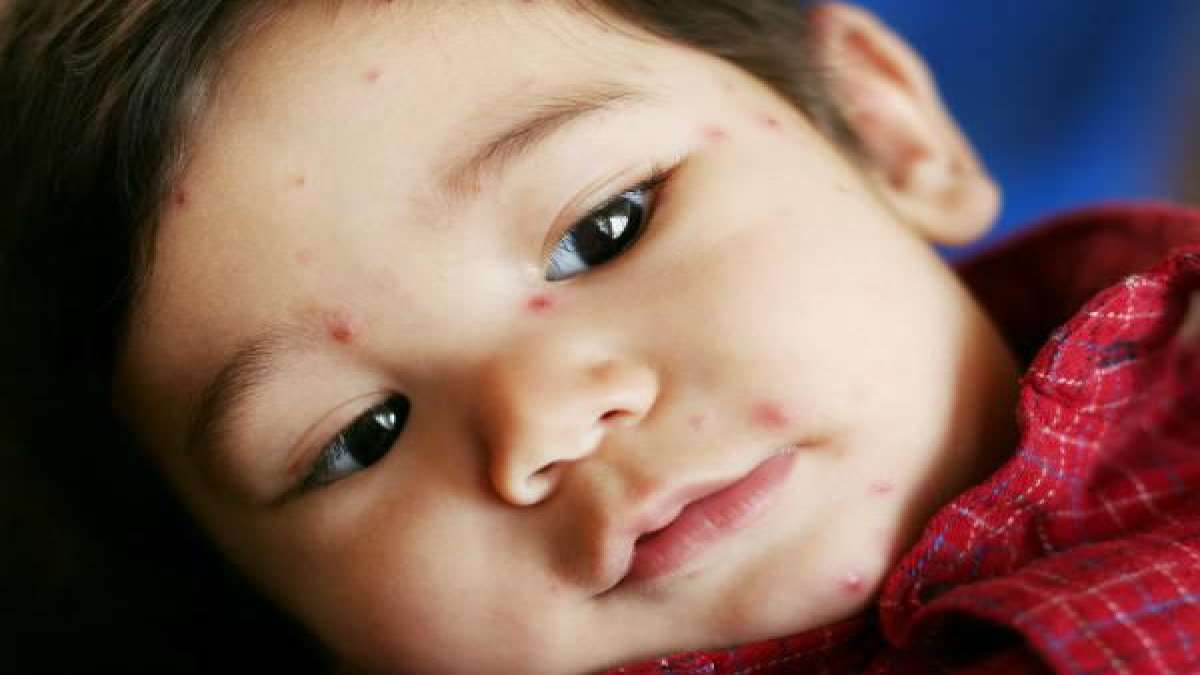 Stages Of Chicken Pox - Boldsky.com
