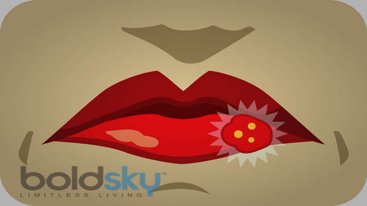 12 Remedies For That Lip Pimple! - Boldsky.com