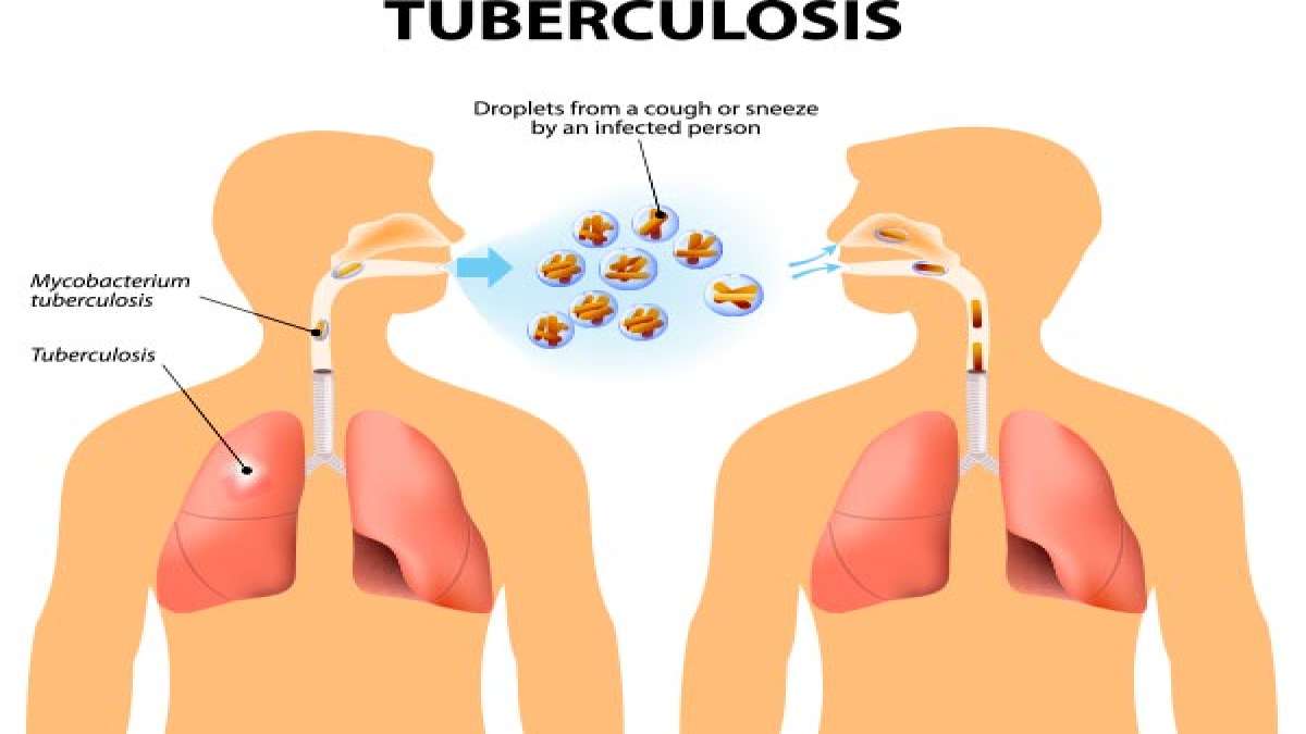 World Tuberculosis Day 2021: Causes, Symptoms & Treatment Of ...
