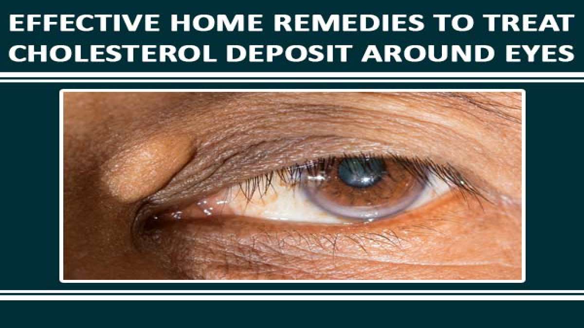 Effective Home Remedies To Treat Cholesterol Deposit Around Eyes ...