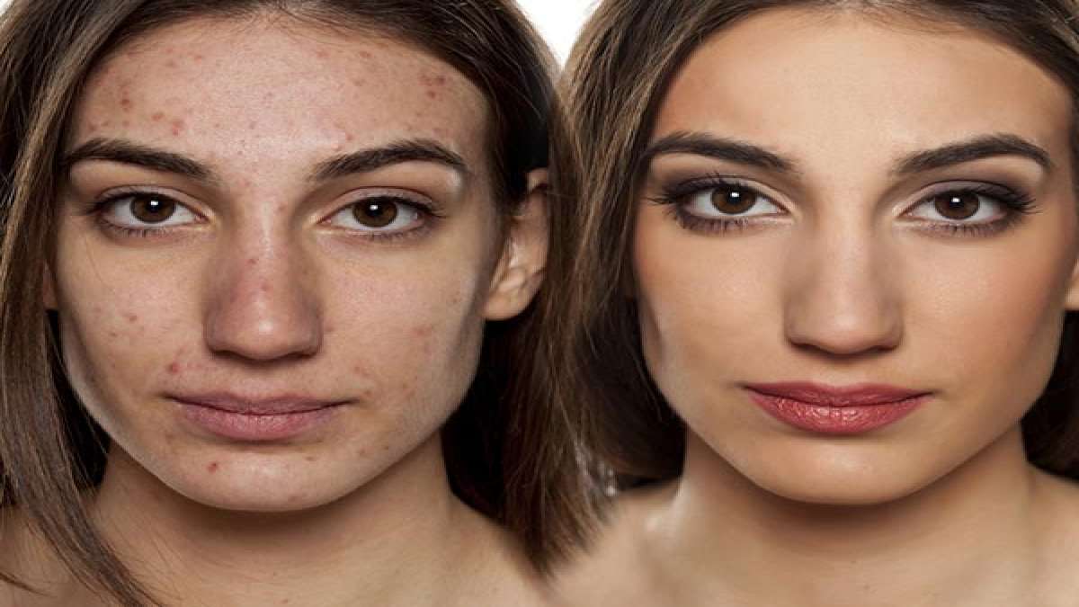 How To Hide Pimple Marks Using Makeup - Boldsky.com