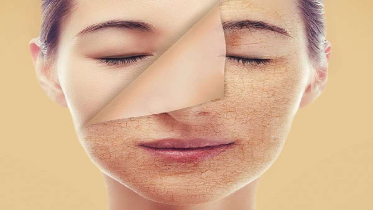 Natural Remedies For Patchy Skin - Boldsky.com