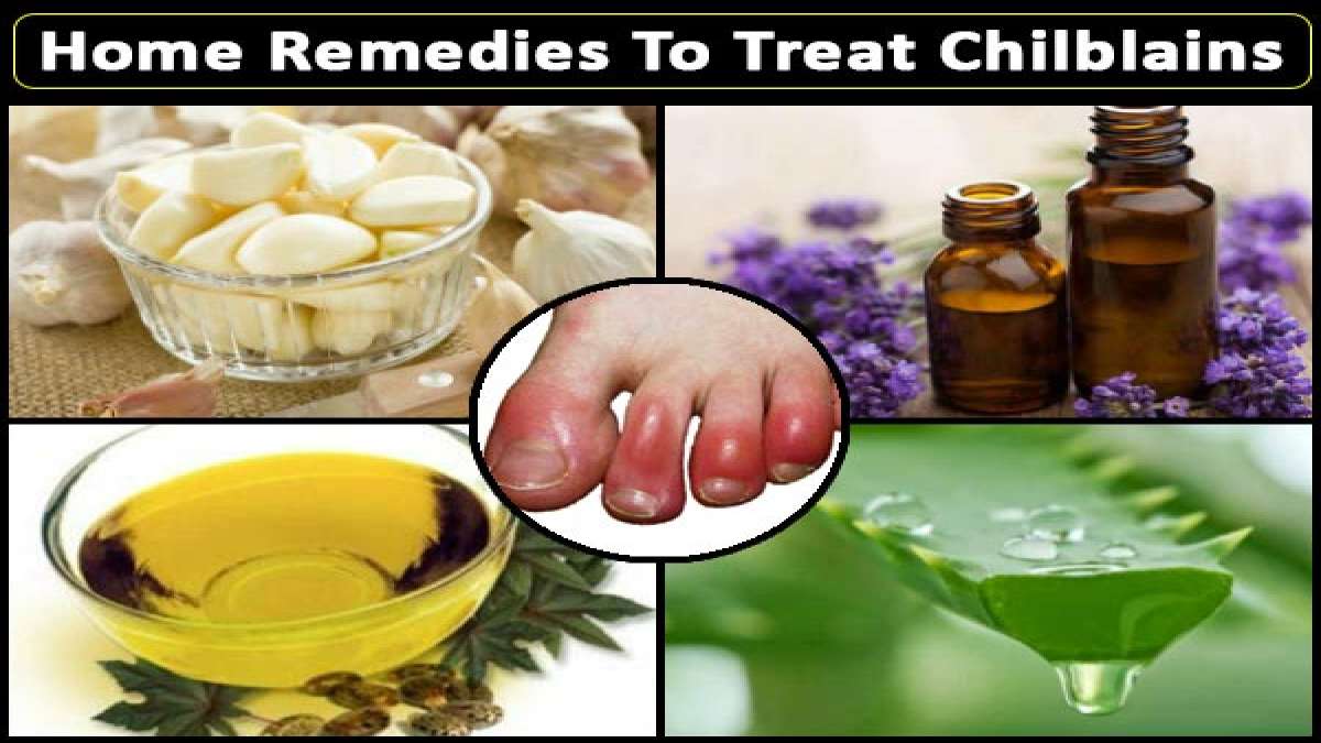 10 Best Home Remedies To Treat Chilblains - Boldsky.com