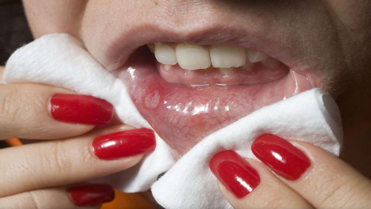 7 Effective Ways To Eliminate Cold Sores Overnight - Boldsky.com