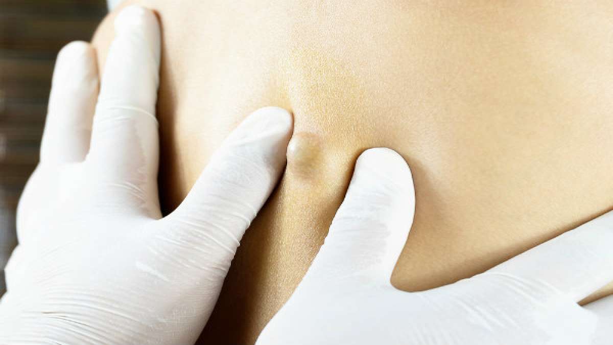 Top Home Remedies For Sebaceous Cyst Removal - Boldsky.com