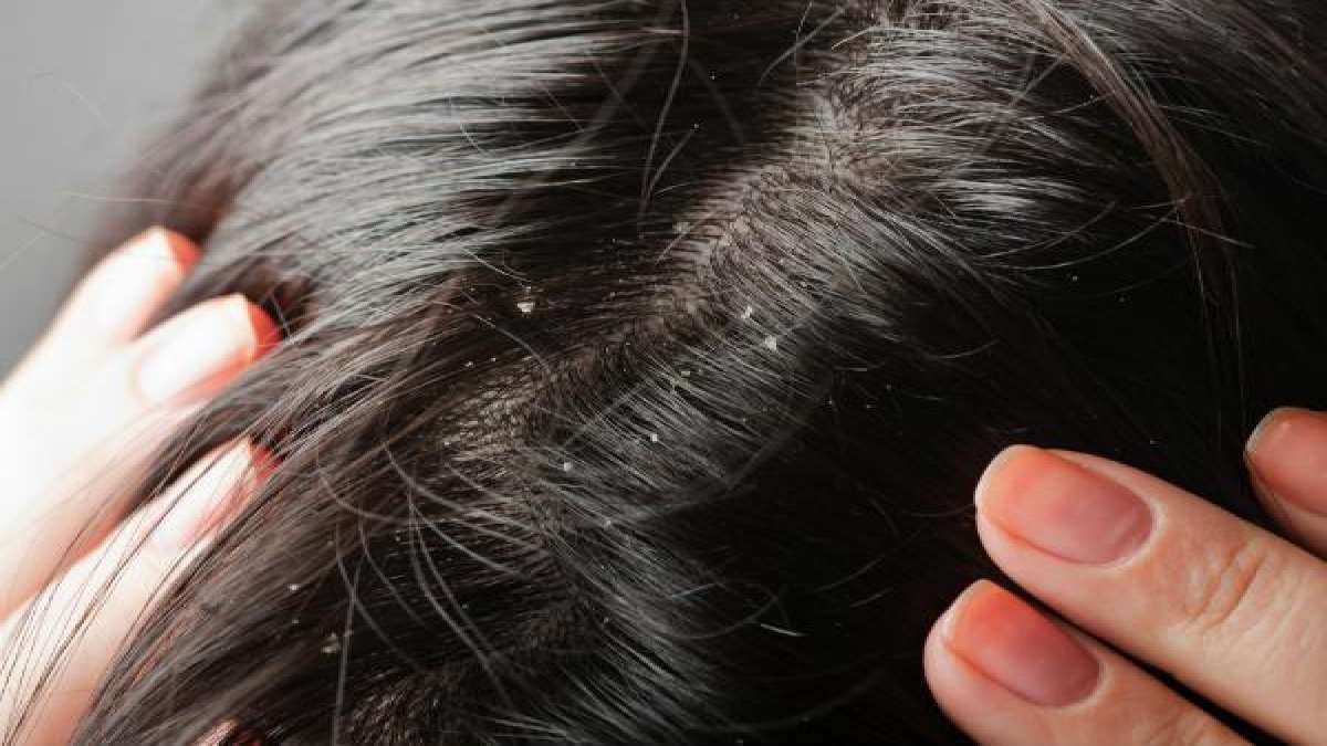 What Is Wet Dandruff And How To Get Rid Of It? - Boldsky.com