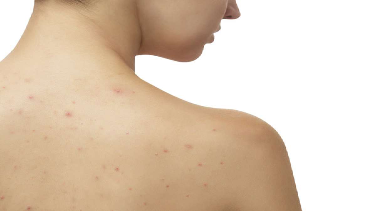 Home Remedies To Treat Shoulder Acne - Boldsky.com