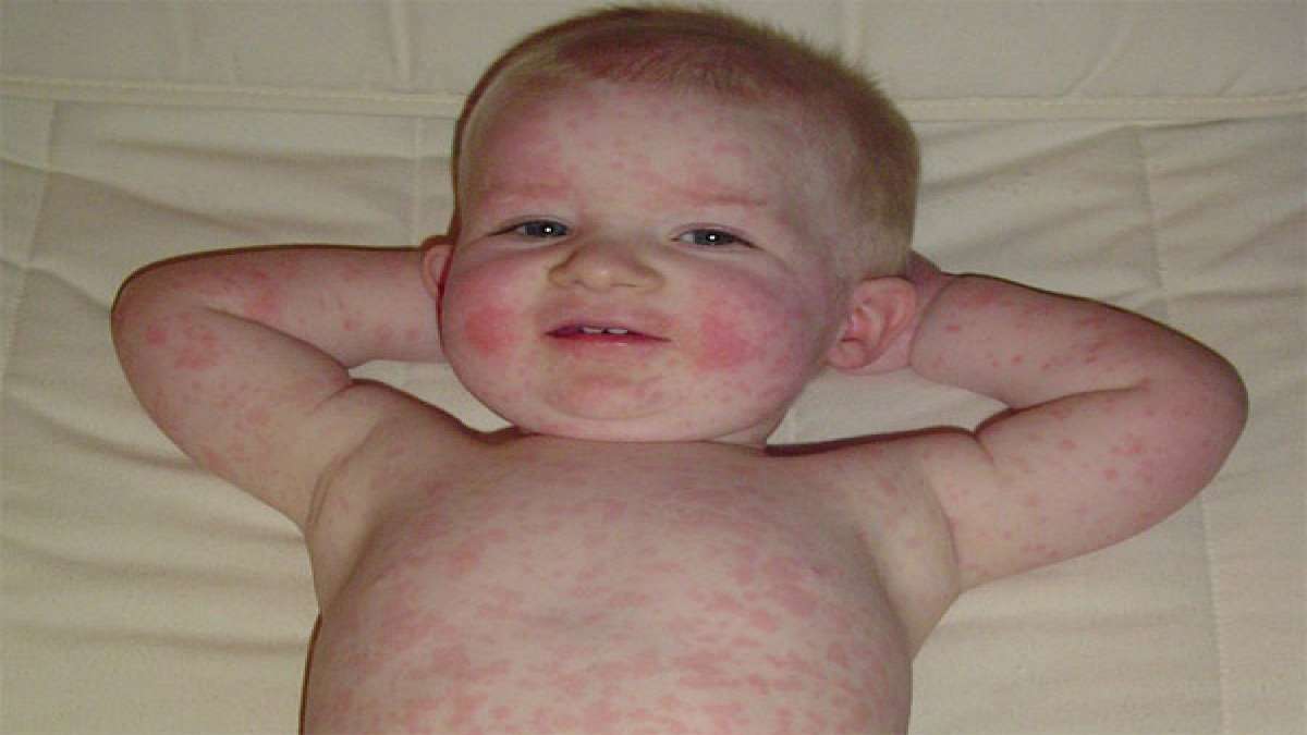 Slapped Cheek Syndrome: All You Need To Know - Boldsky.com