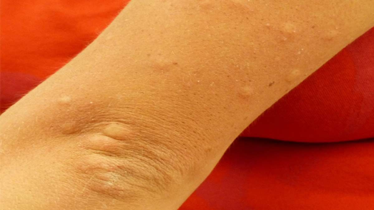 Typhus - Causes, Symptoms, Treatment And Prevention - Boldsky.com