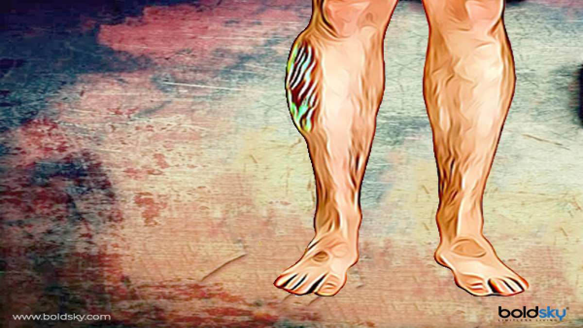 Liposarcoma: Types, Symptoms, Causes, Diagnosis & Treatment - Boldsky.com