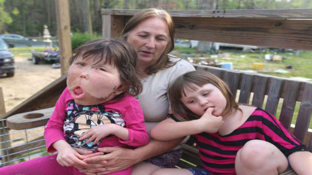 Rare Disease Day: Top 20 Rare Diseases In The World - Boldsky.com