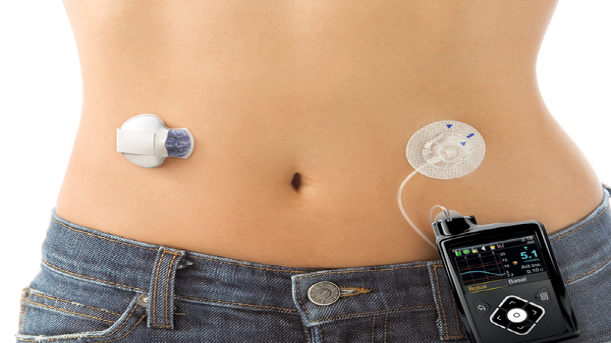 Insulin Pump Therapy: How It Works, Advantages & Disadvantages ...