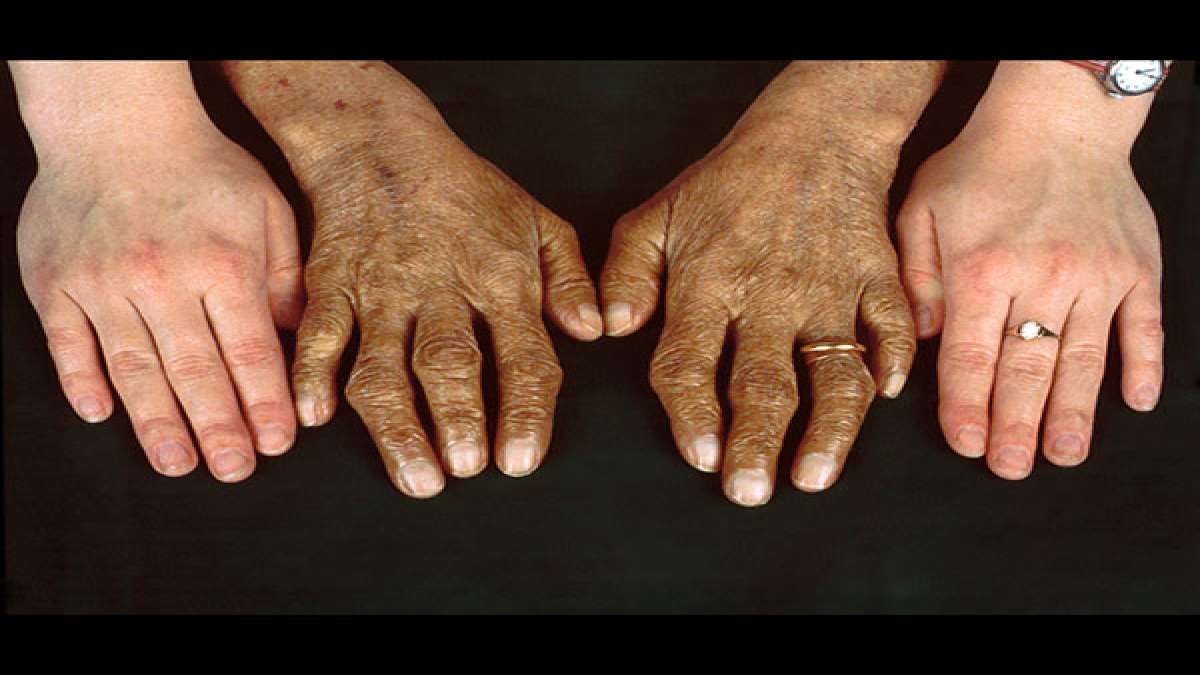 Haemochromatosis (Iron Overload): Types, Symptoms, Causes, Diagnosis ...