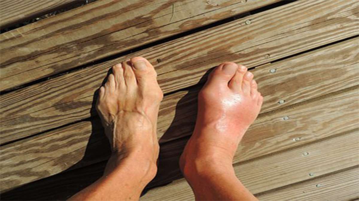 Bunions: Causes, Symptoms, Diagnosis, Treatment And Prevention ...