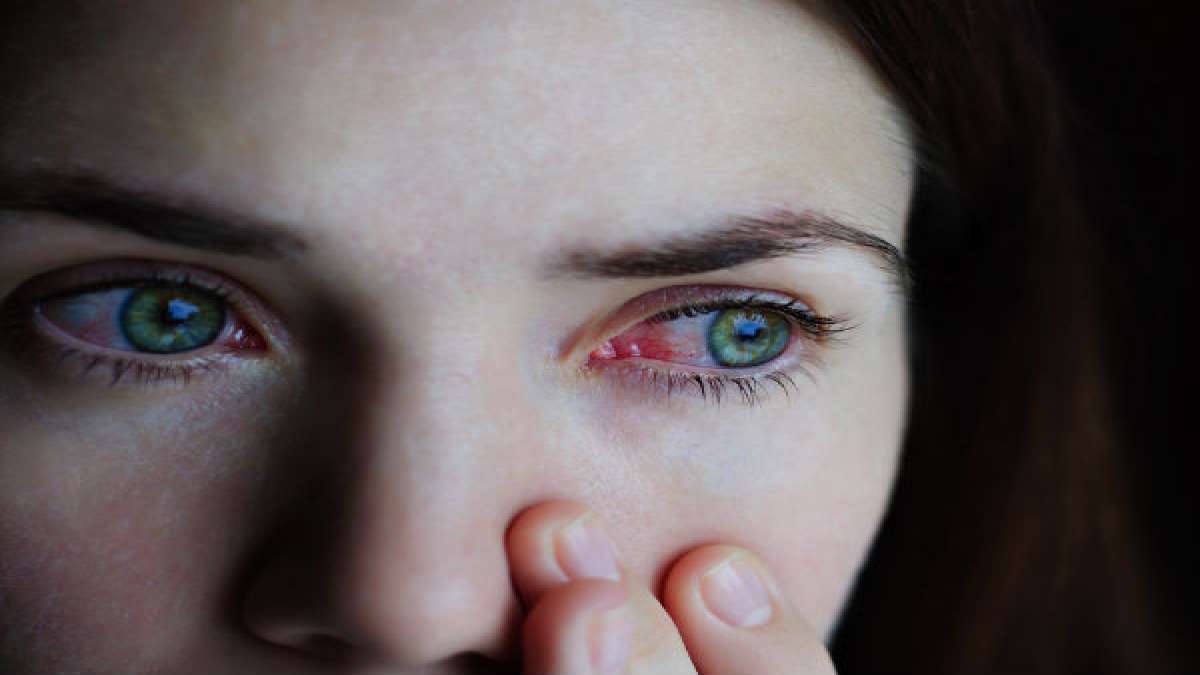 Conjunctivitis: Causes, Symptoms, Diagnosis & Treatment - Boldsky.com