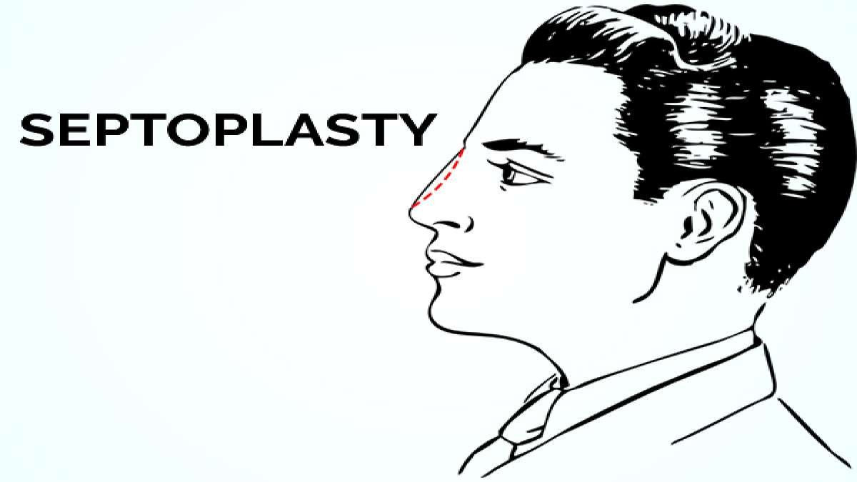 Everything You Need To Know About Septoplasty - Boldsky.com
