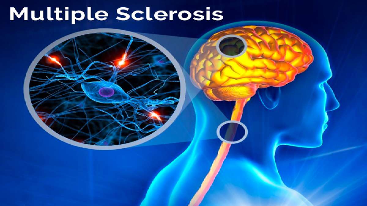 Multiple Sclerosis: Causes, Symptoms, Diagnosis And Treatment - Boldsky.com