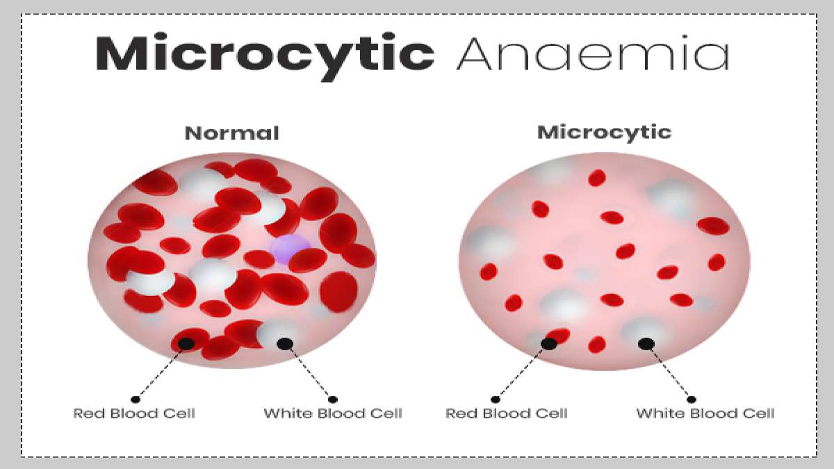 Microcytic Anemia: Symptoms, Causes, Risk Factors, Treatment, And ...