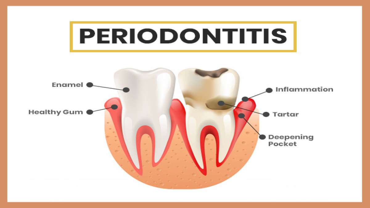 Periodontitis: Symptoms, Causes, Risk factors, Treatment And Prevention ...