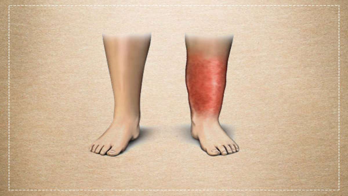 Cellulitis: Causes, Types, Symptoms, Diagnosis & Treatment - Boldsky.com
