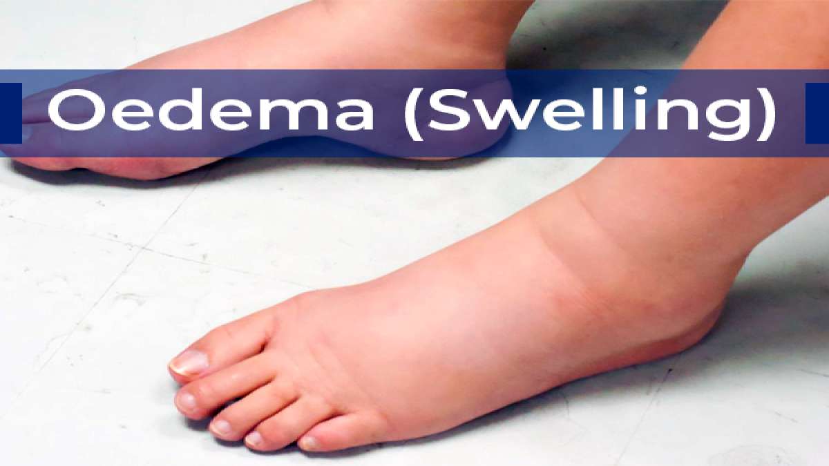Oedema: Types, Causes, Symptoms, Treatment And Management - Boldsky.com