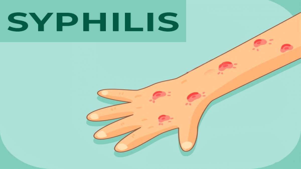 Syphilis Causes Symptoms Diagnosis And Treatment