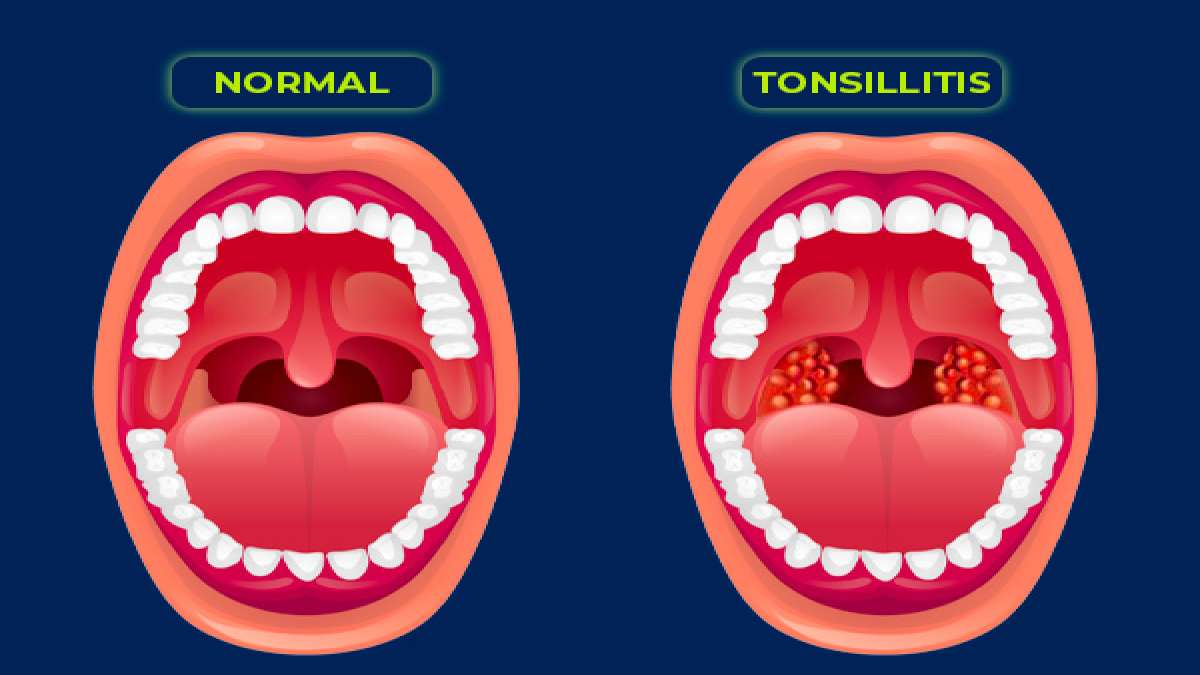 Tonsillitis: Causes, Symptoms, Diagnosis And Treatment - Boldsky.com