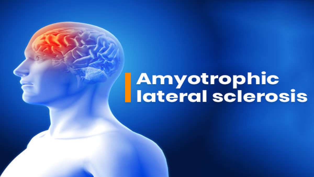 Amyotrophic Lateral Sclerosis: Causes, Symptoms, Diagnosis And ...