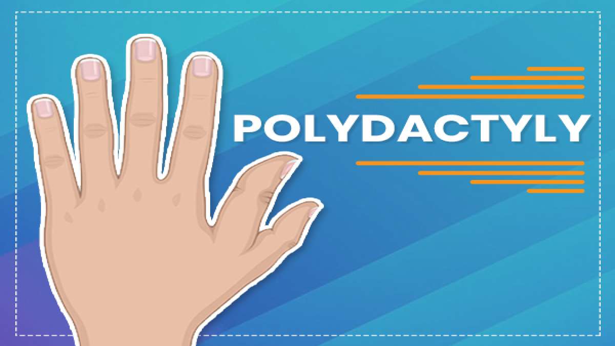 Polydactyly: Causes, Symptoms, Diagnosis And Treatment - Boldsky.com