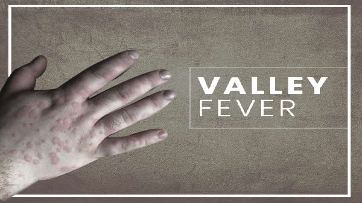 Valley Fever: Causes, Symptoms, Risk Factors, Diagnosis And Treatment ...