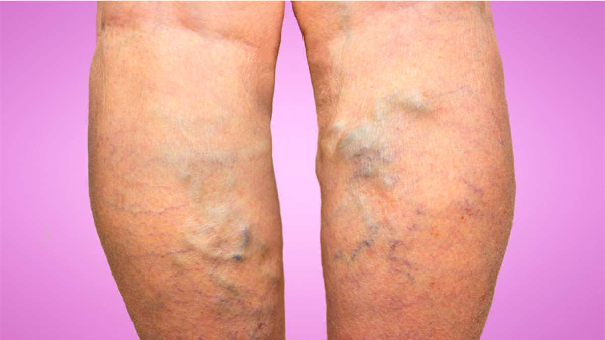 Varicose Veins: Causes, Symptoms, Diagnosis And Treatment - Boldsky.com