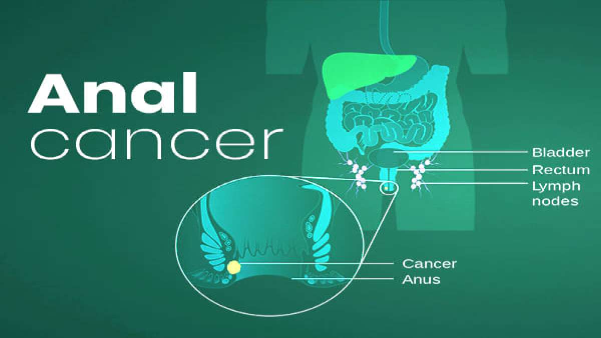 Anal Cancer: Causes, Symptoms, Diagnosis And Treatment - Boldsky.com