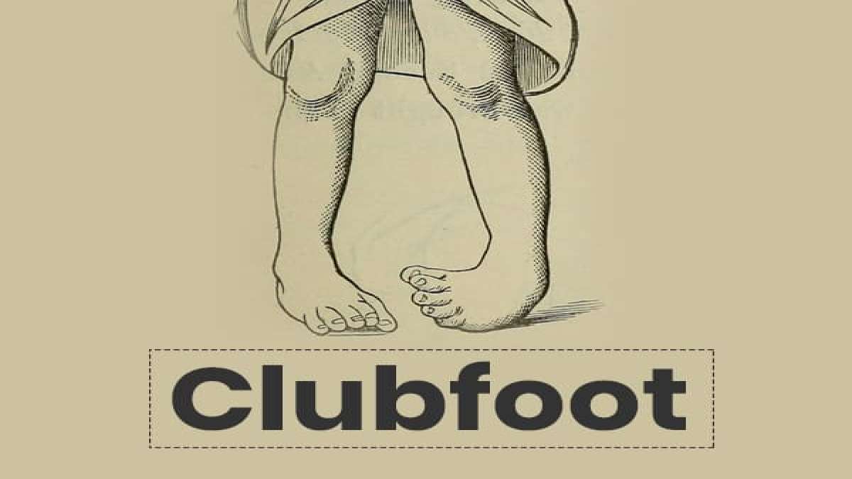 Clubfoot: Causes, Symptoms, Risk Factors, Diagnosis, Treatment And ...