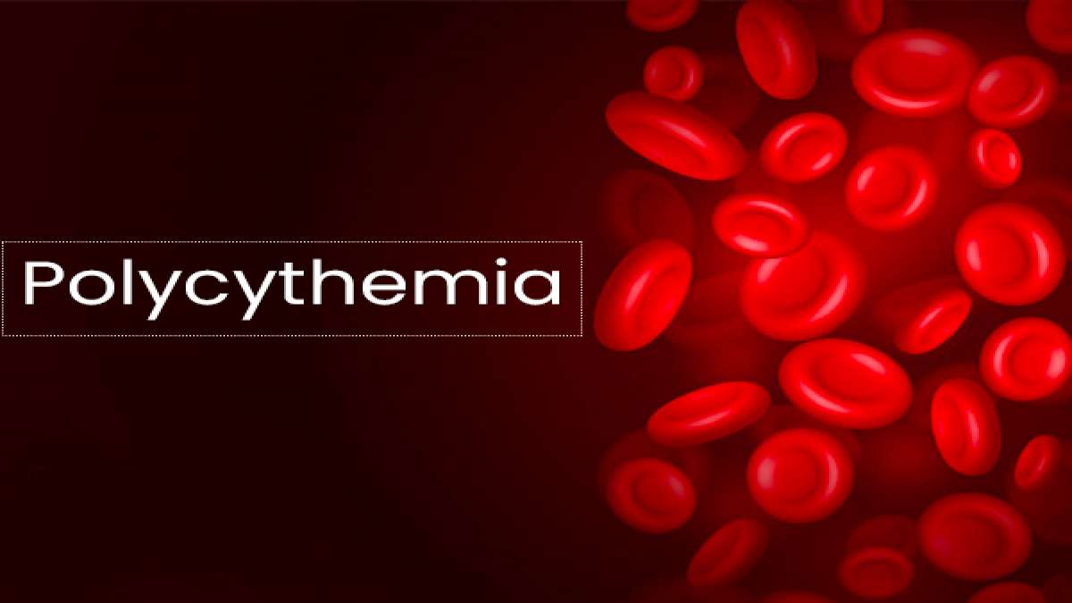 Polycythemia: Causes, Symptoms, Risk Factors, Diagnosis, Treatment And ...
