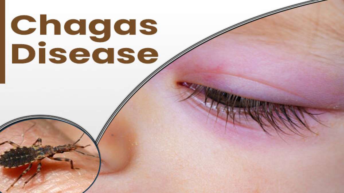 Chagas Disease: Causes, Symptoms, Risk Factors, Treatment And ...