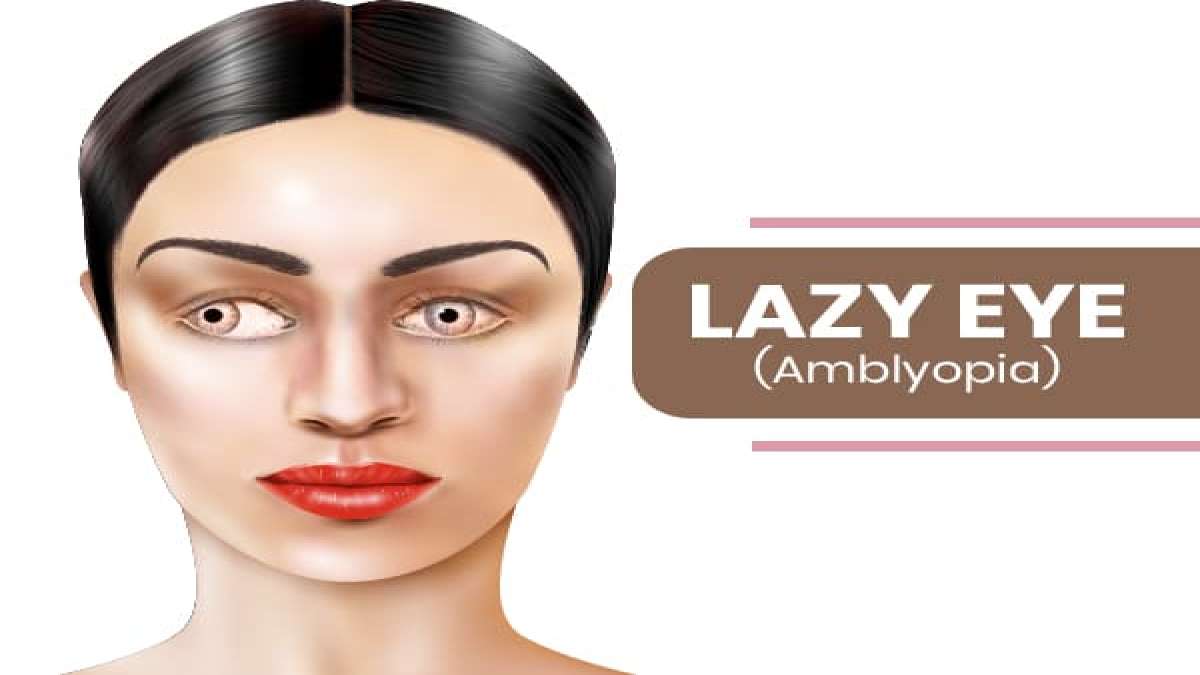 Lazy Eye (Amblyopia): Causes, Symptoms, Risk Factors, Diagnosis And ...