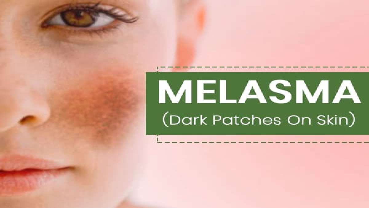 Melasma (Chloasma): What Are The 6 Factors That Cause It? Symptoms ...