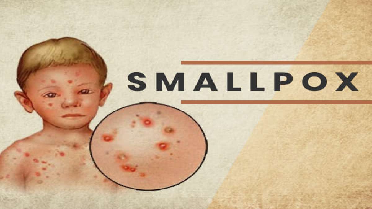 Smallpox: History, Causes, Symptoms, Diagnosis And Treatment - Boldsky.com