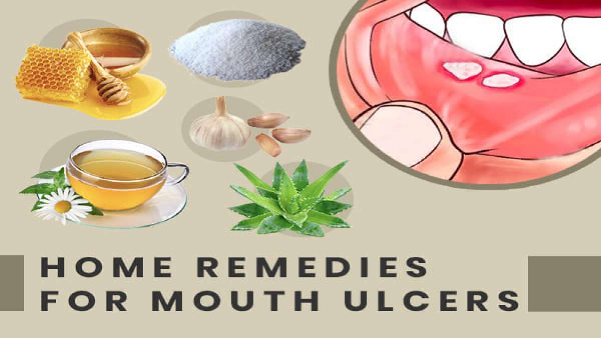 10 Home Remedies That May Help Heal Mouth Ulcers - Boldsky.com