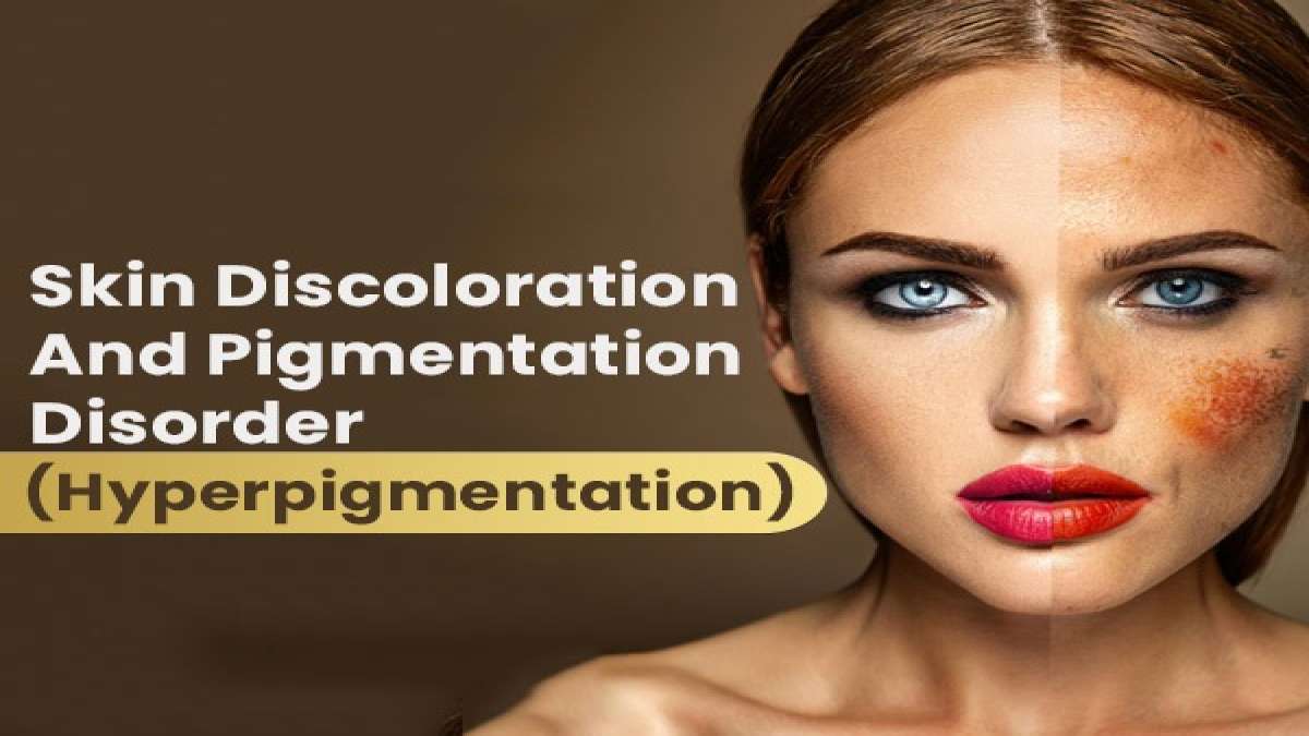 Is Hyperpigmentation A Serious Skin Condition? Know About The Causes ...