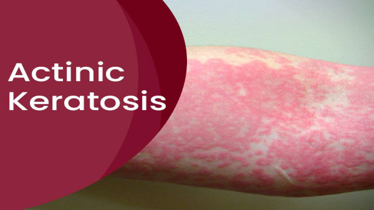 Actinic Keratosis Causes Symptoms Risk Factors Treatments And