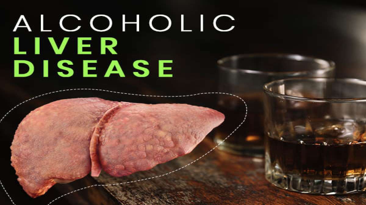 Alcoholic Liver Disease: Causes, Stages, Symptoms, Risk Factors ...