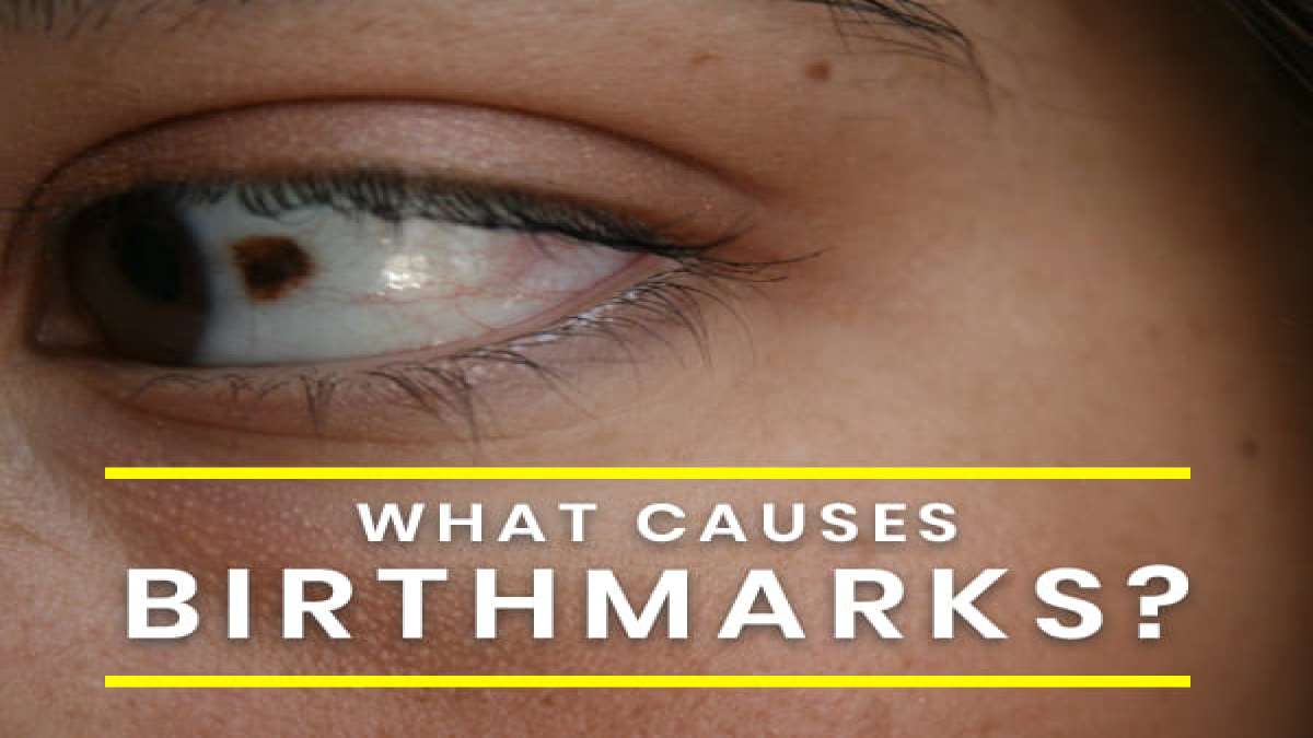 Do You Have A Birthmark? Its Causes, Types, Complications And Treatment ...