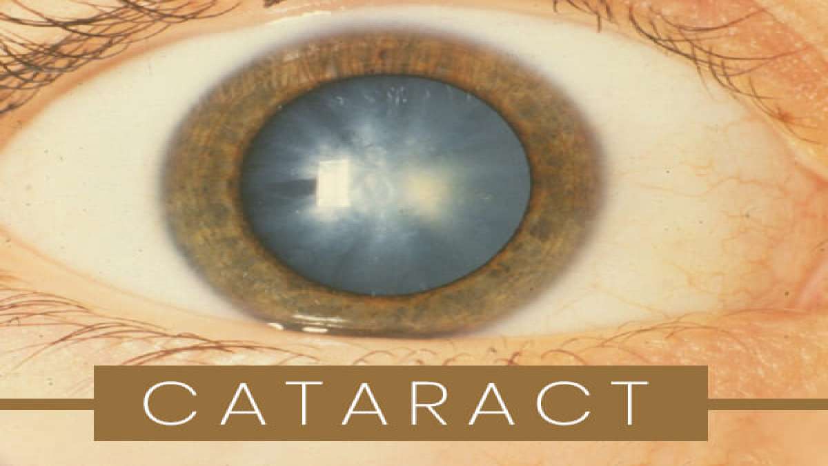 Cataract: Types, Causes, Symptoms, Diagnosis And Treatment - Boldsky.com