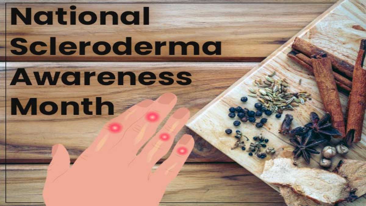 National Scleroderma Awareness Month: Home Remedies For Scleroderma ...