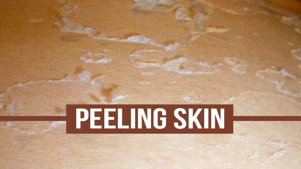 Peeling Skin: Causes, Symptoms, Diagnosis And Treatment - Boldsky.com