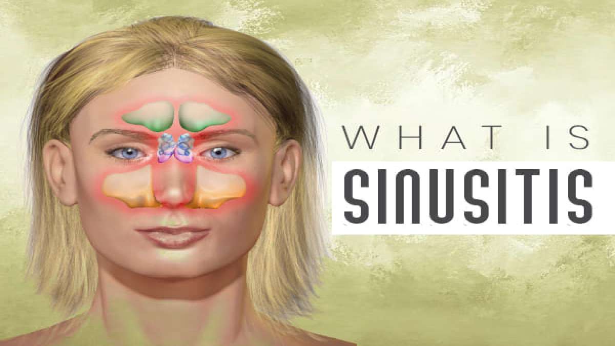 What Is Sinusitis? Causes, Symptoms, Risk Factors, Diagnosis And ...