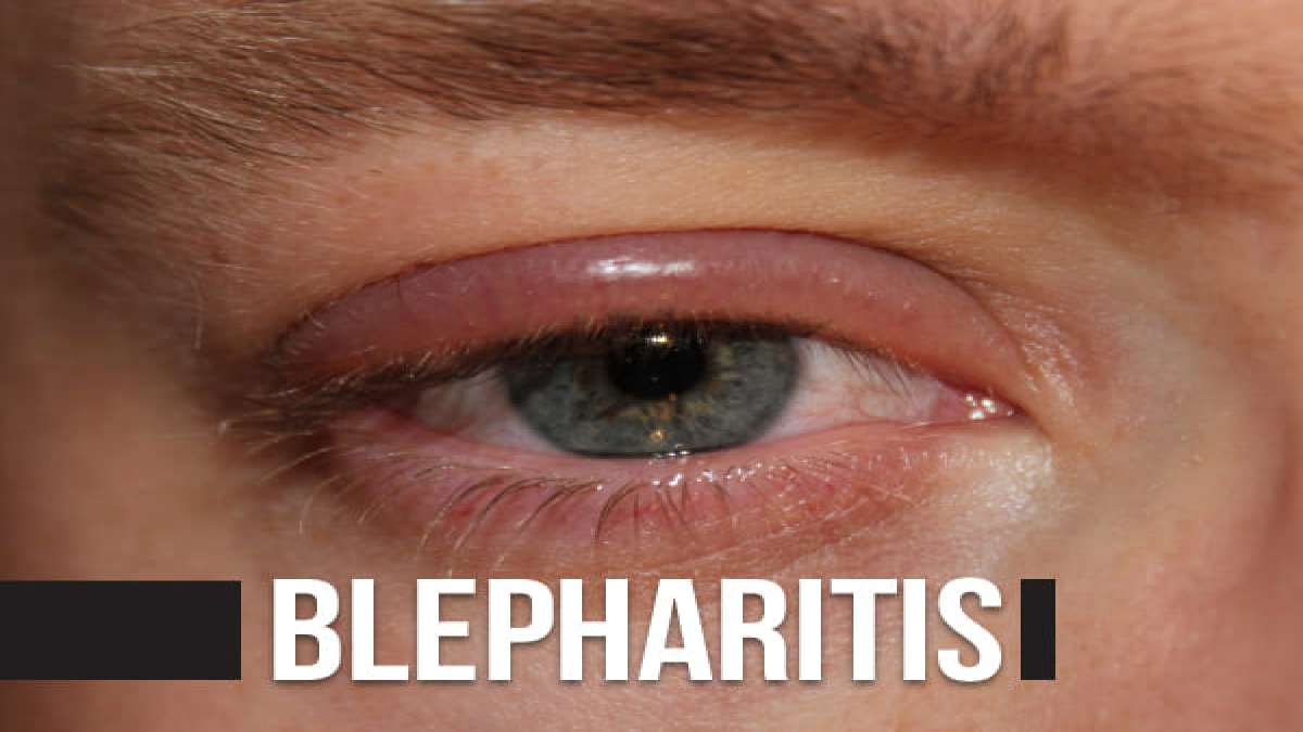 Blepharitis (Eyelid Inflammation):Causes, Types, Symptoms, Diagnosis ...